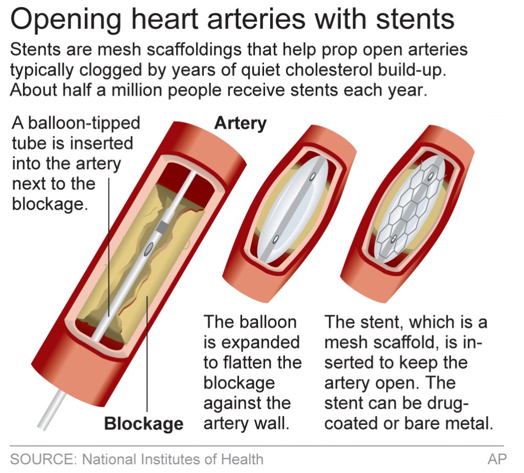 Kalp Damarına Stent Takılması Aşamaları, Riskleri ve İyileşme Süreci